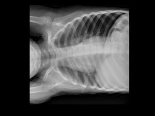 Infant Pneumothorax X Ray