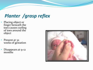 Plantar Grasp Reflex