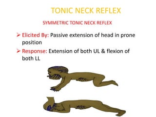 Neonatal Reflexes Case Presentation pptx Neonatal Reflexes Case Presentation pptx