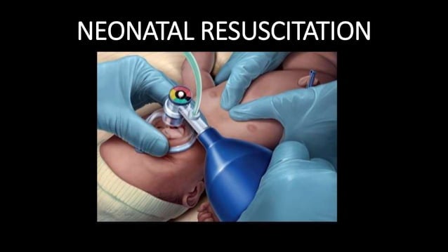 Neonatal resuscitation | PPTX | First Aid | Injuries