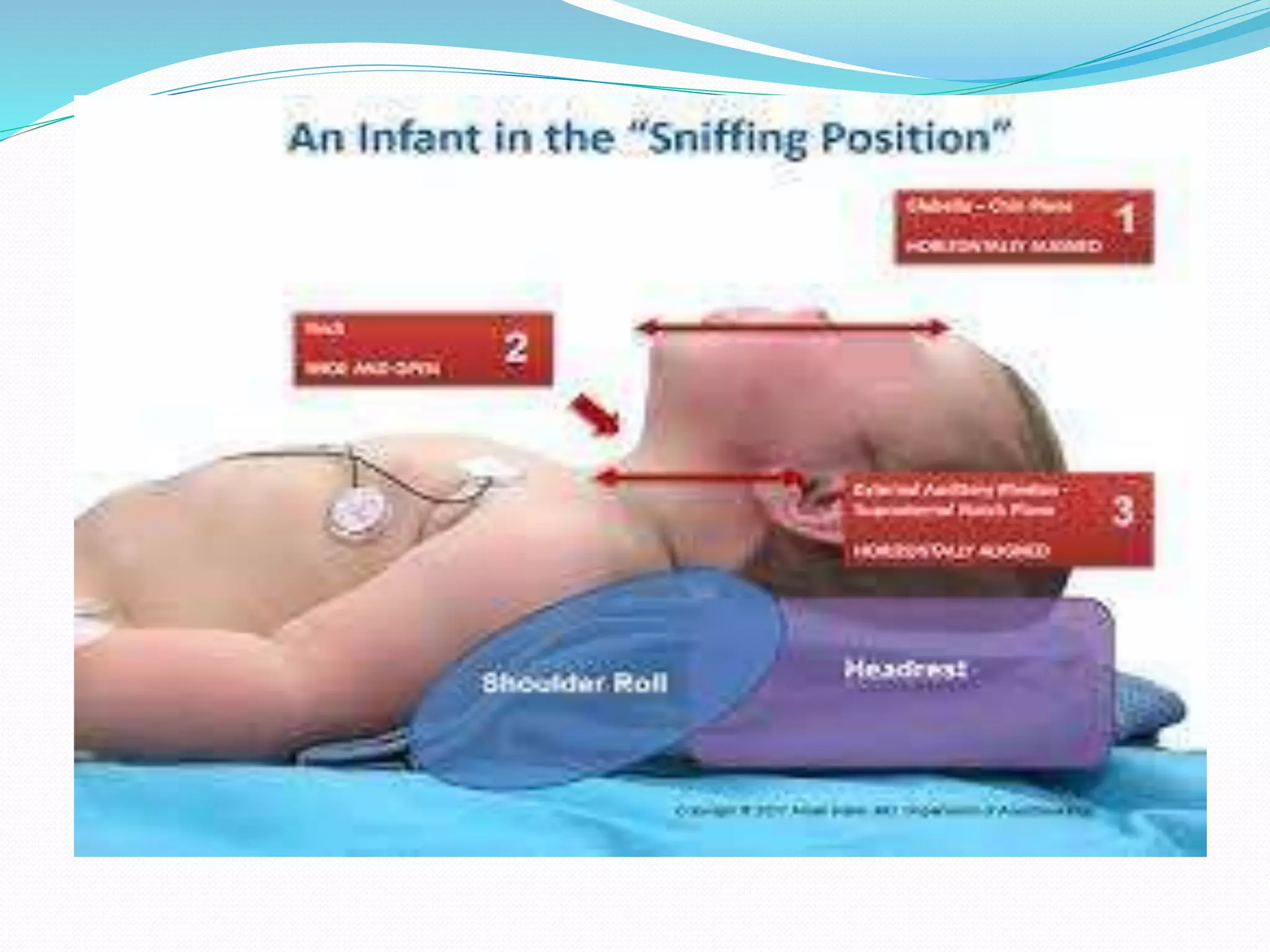 Neonatal resuscitation 1 | PPTX