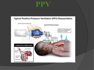 PPT Neonatal Resuscitation Provider PowerPoint, 42% OFF