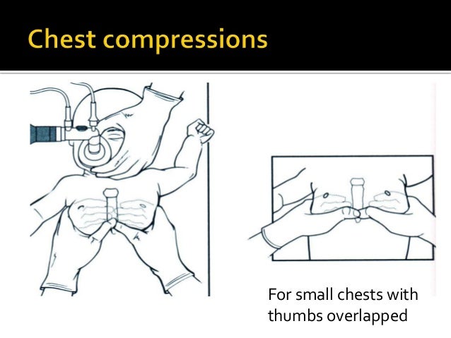 Neonatal resuscitation programme, NRP