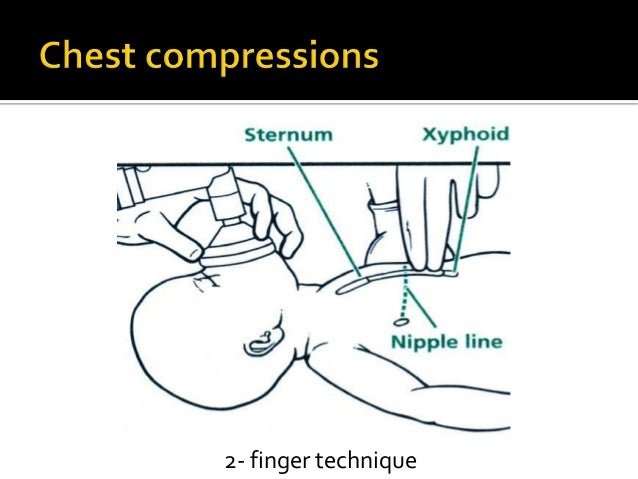 Neonatal resuscitation programme, NRP