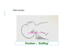 NnnnnNeonatal Resuscitation shortttt.pdf | First Aid | Injuries