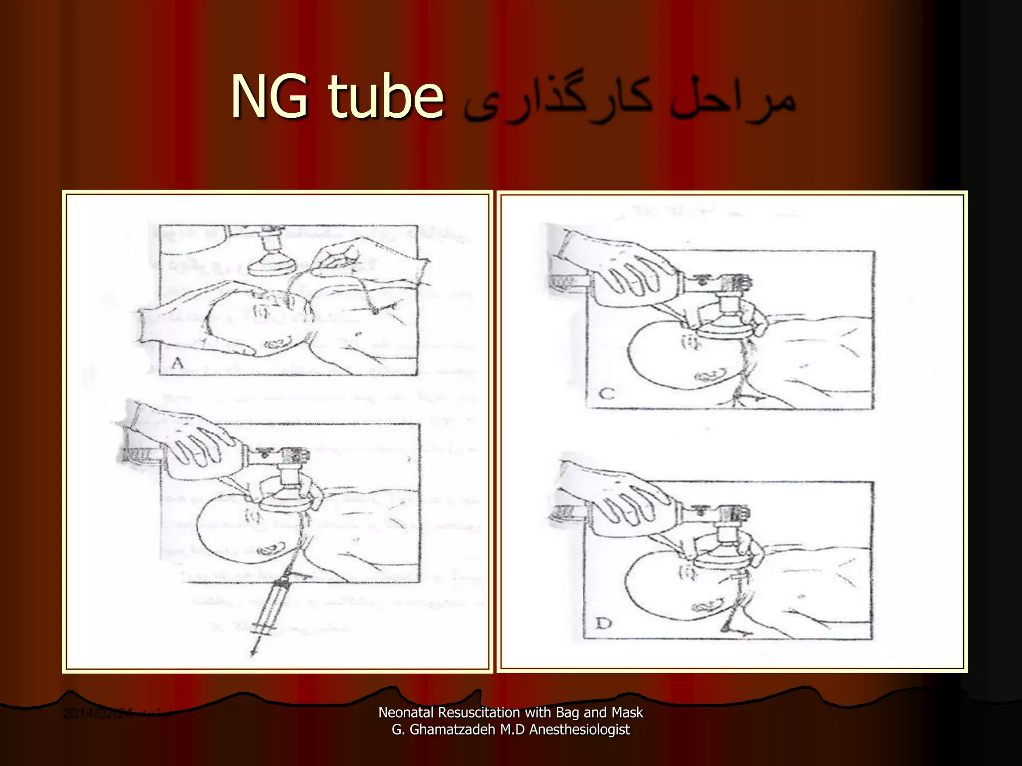 Neonatal resuscitation with bag & mask | PPSX | First Aid | Injuries