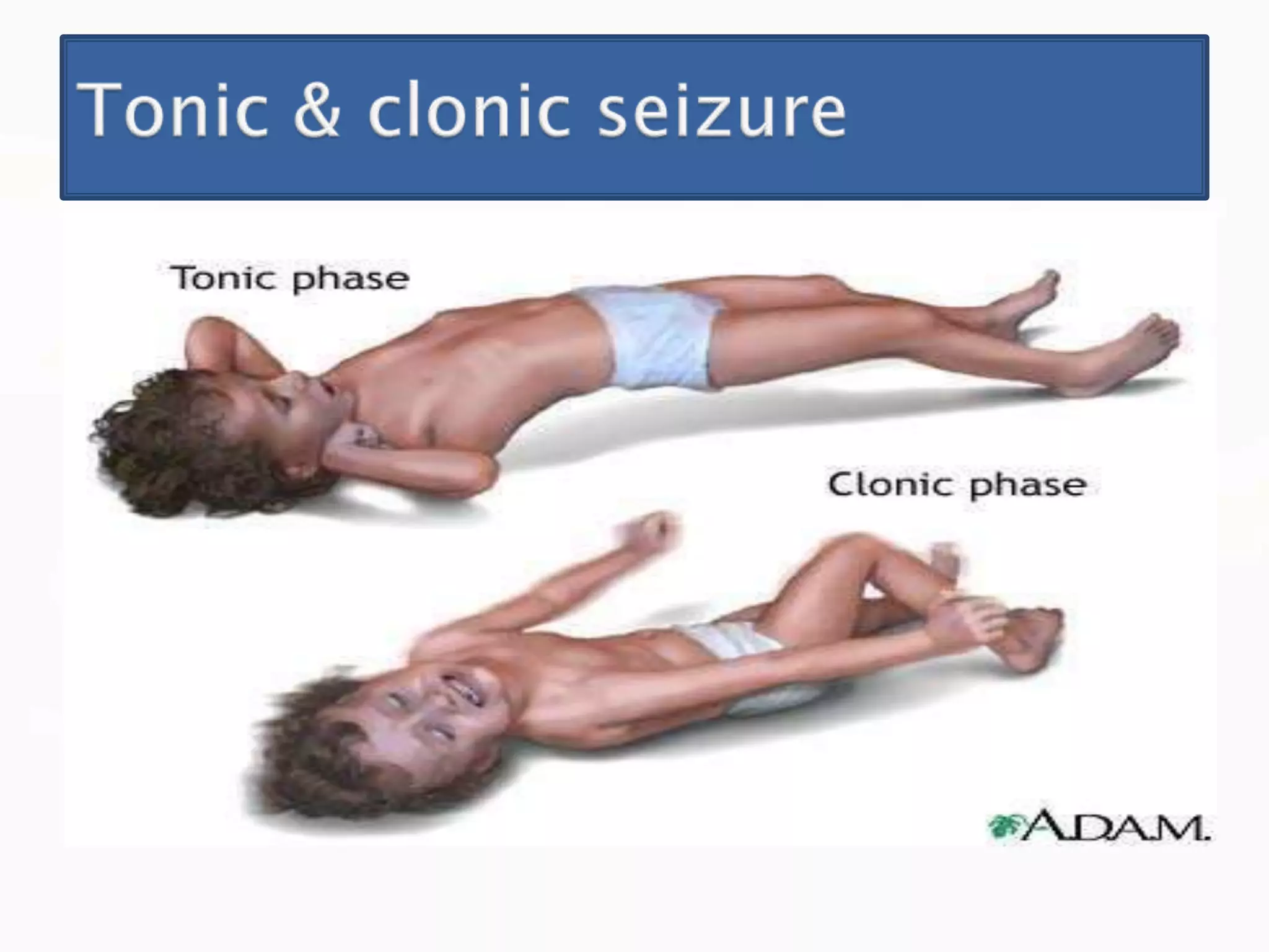 Neonatal seizure | PPTX