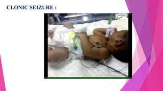 Neonatal seizure and its nursing management | PPTX