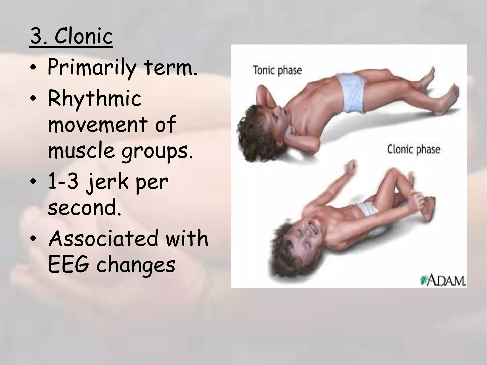 Neonatal seizures | PPSX