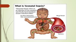 Neonatal sepsis | PPTX