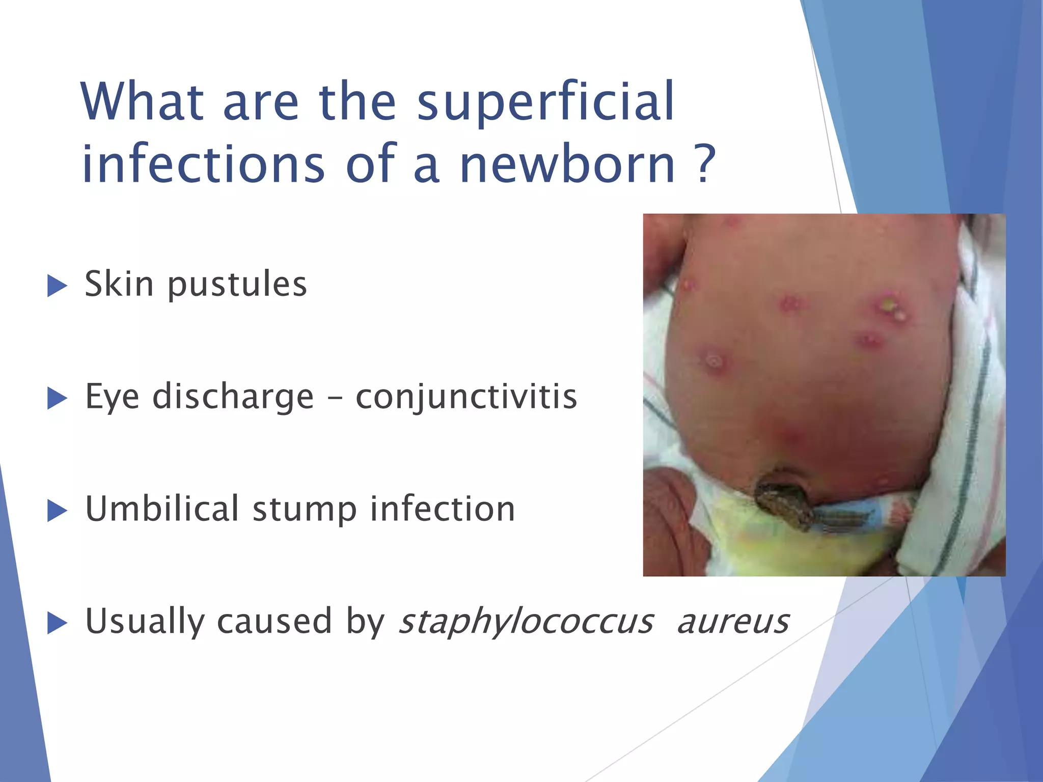 Neonatal sepsis tharindu n gunasiri | PPT