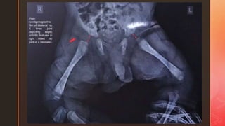 Neonatal septic arthritis | PPTX