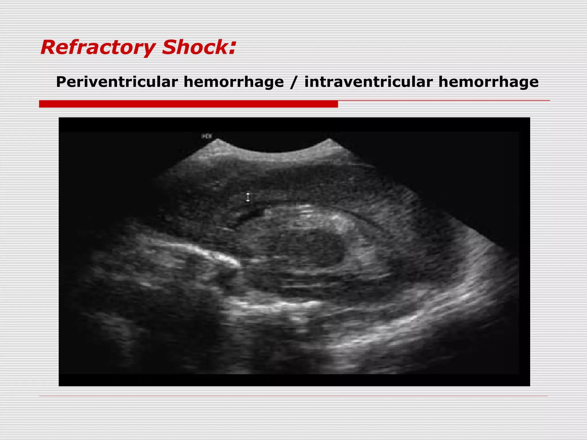 Neonatal shock | PPT