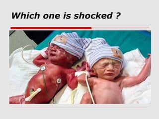 Neonatal shock | PPT