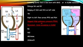 Neonatal shock may 2021 | PDF