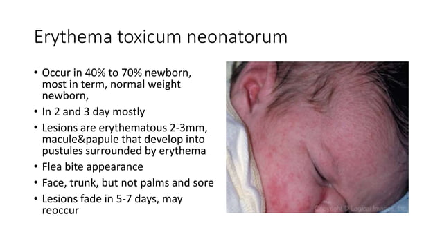 Neonatal skin rashes | PPT | Free Download