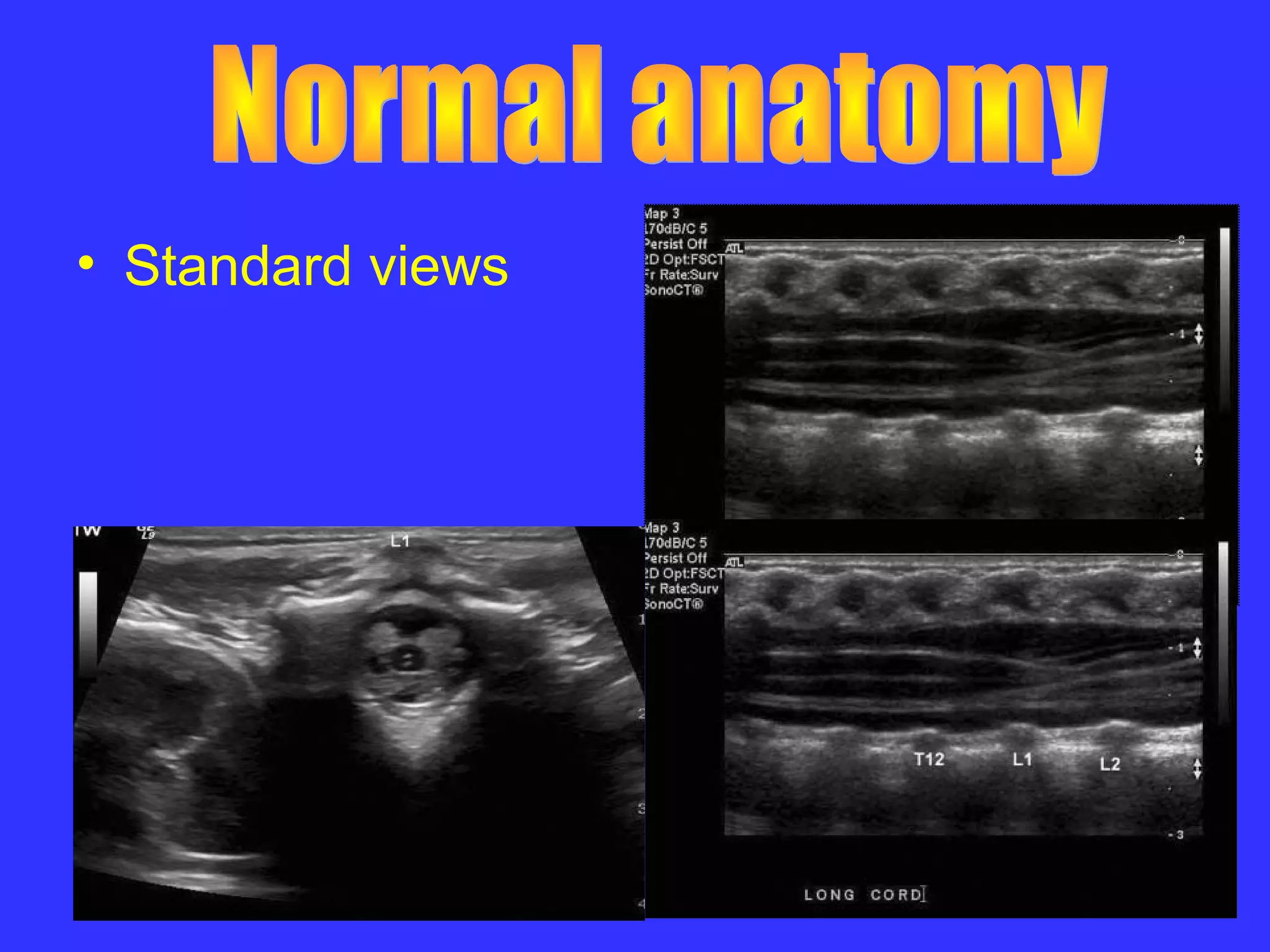 Neonatal spine ultrasound...normal and abnormal findings | PPT