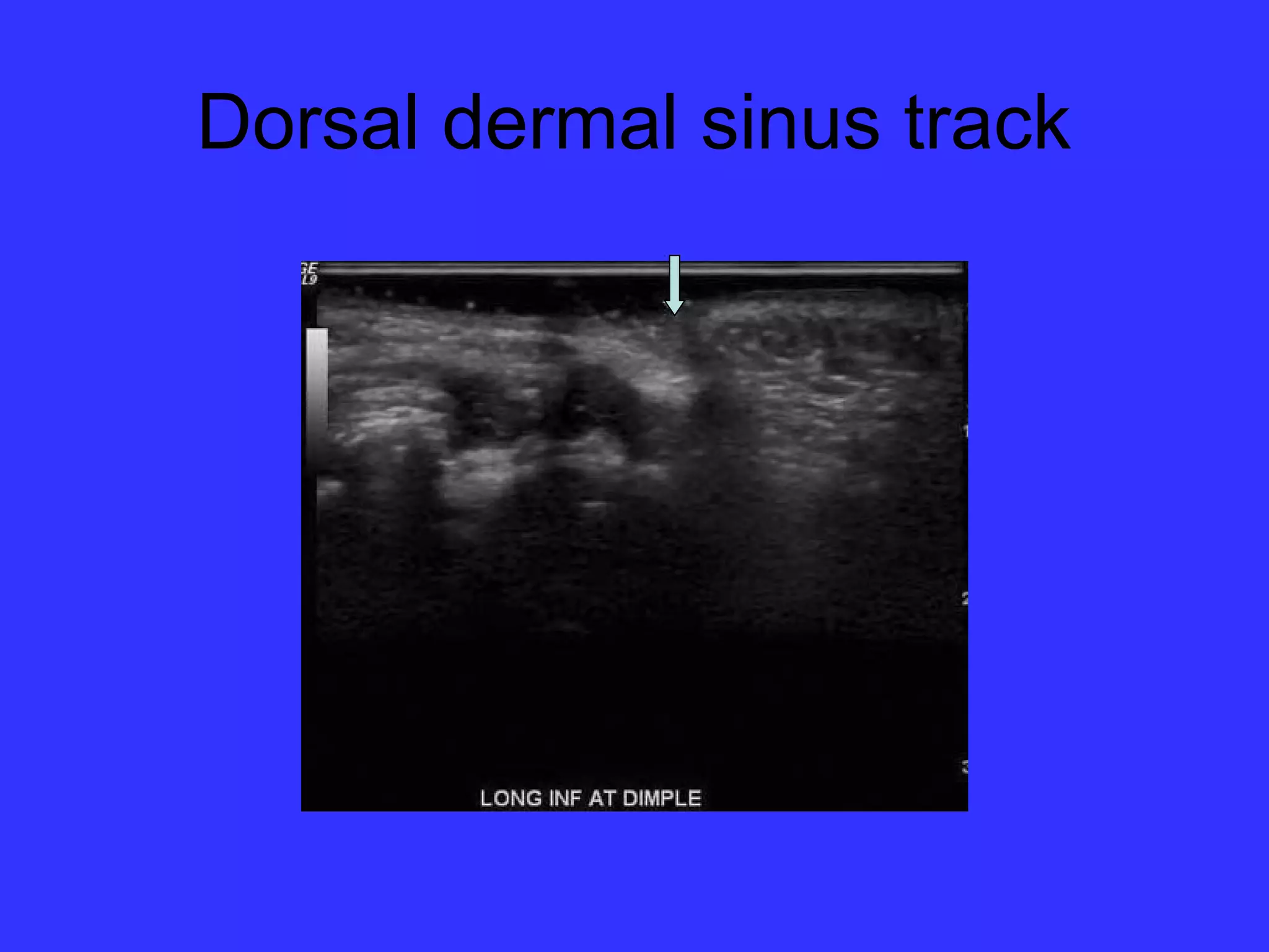 Neonatal spine ultrasound...normal and abnormal findings | PPT