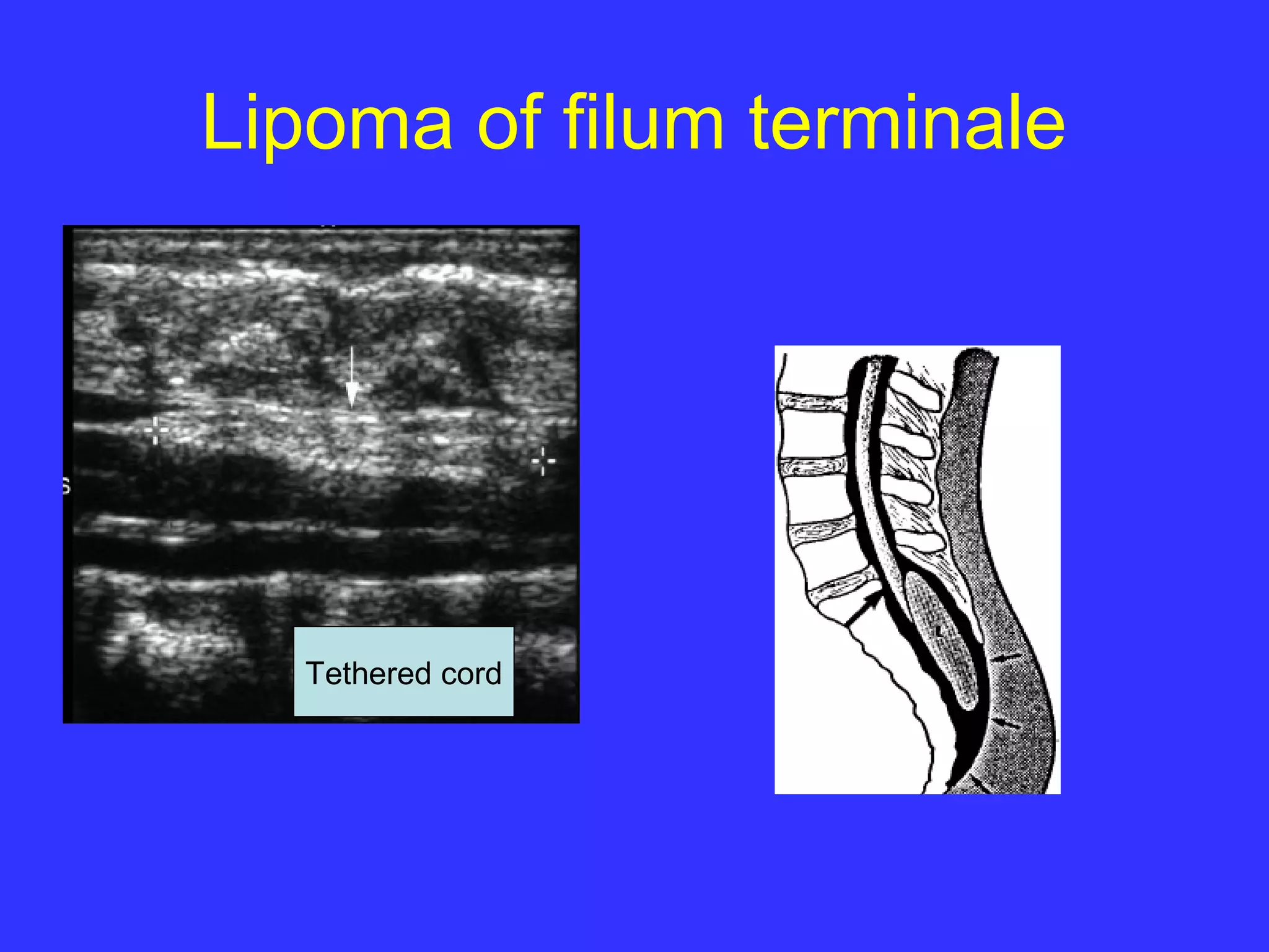 Neonatal spine ultrasound...normal and abnormal findings | PPT