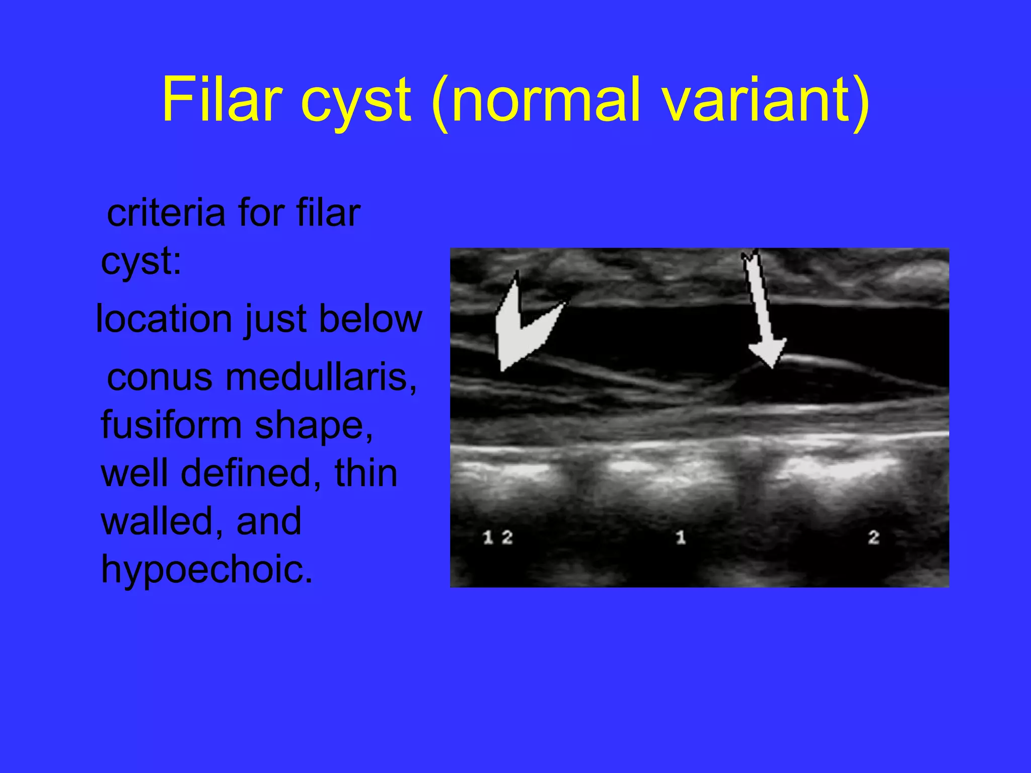 Neonatal spine ultrasound...normal and abnormal findings | PPT