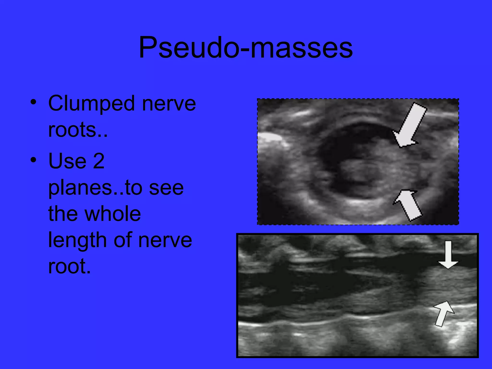 Neonatal spine ultrasound...normal and abnormal findings | PPT