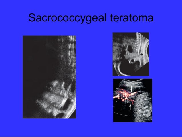 Neonatal spine ultrasound...normal and abnormal findings | PPT ...