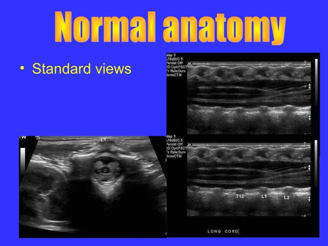 Neonatal spine ultrasound...normal and abnormal findings