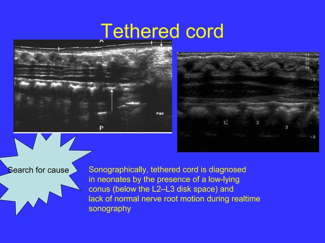 Neonatal spine ultrasound...normal and abnormal findings