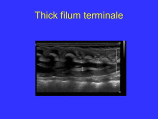 Filum Terminale Ultrasound
