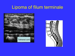 Filum Terminale Ultrasound