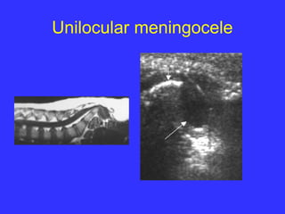 Meningocele Ultrasound