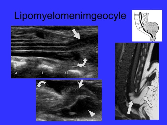 Neonatal spine ultrasound...normal and abnormal findings