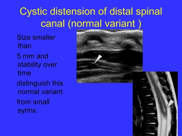 Neonatal spine ultrasound...normal and abnormal findings