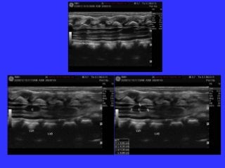 Filum Terminale Ultrasound