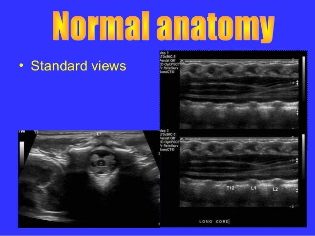 Neonatal spine ultrasound...normal and abnormal findings