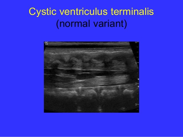 Neonatal spine ultrasound...normal and abnormal findings