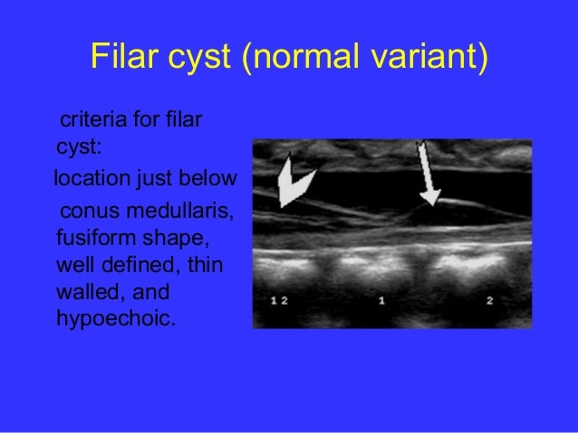 Neonatal spine ultrasound...normal and abnormal findings