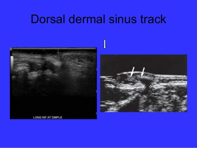 A Sagittal Spinal Ultrasound Showing Lipoma Of The Filum