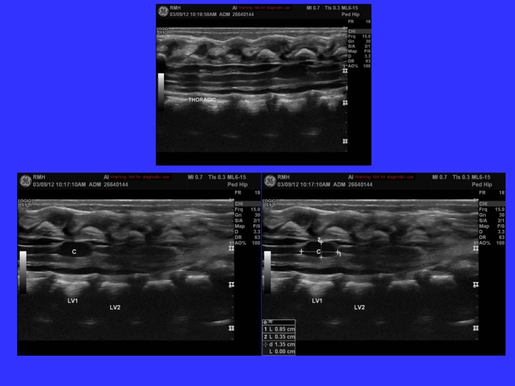 Neonatal spine ultrasound...normal and abnormal findings