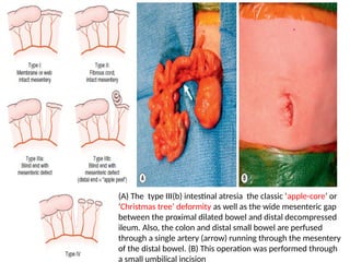Neonatal Surgical conditions 0f abdomen.pptx