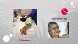 Neonatal tetanus | PPTX