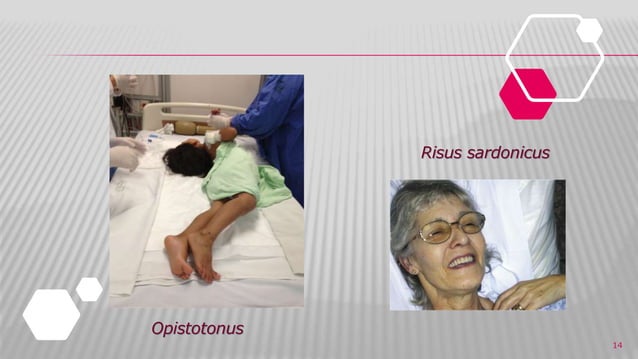 Neonatal tetanus | PPTX | Infectious Diseases | Diseases and Conditions