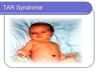 Neonatal thrombocytopenia | PPT