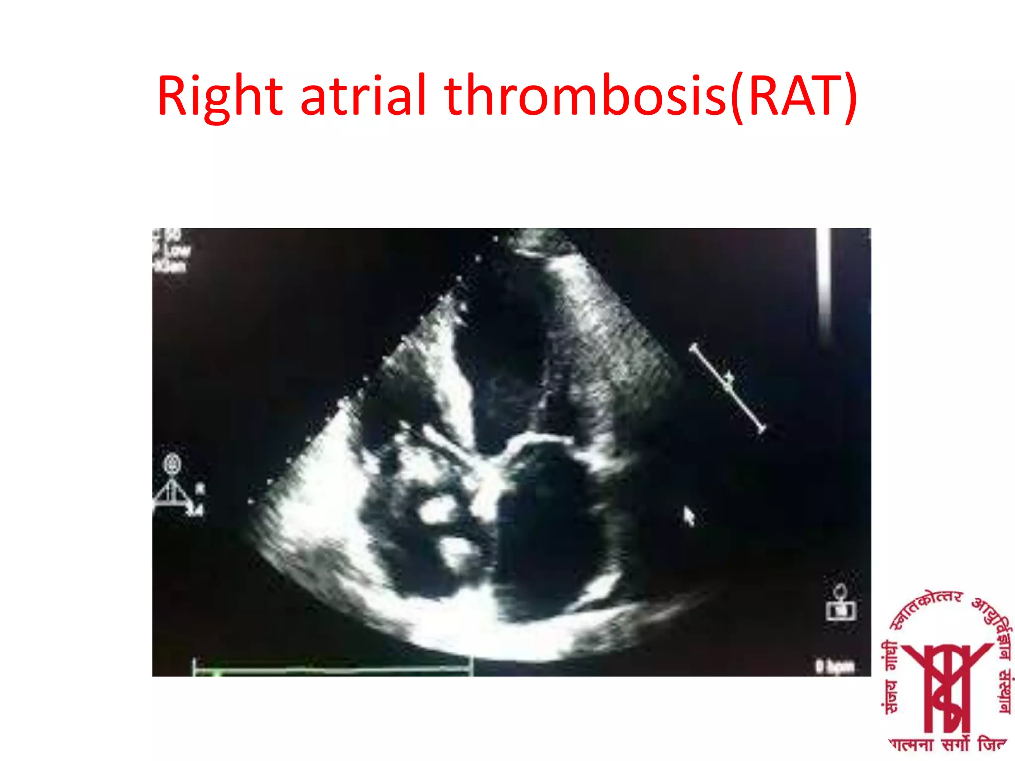 Neonatal thrombosis amit | PPTX