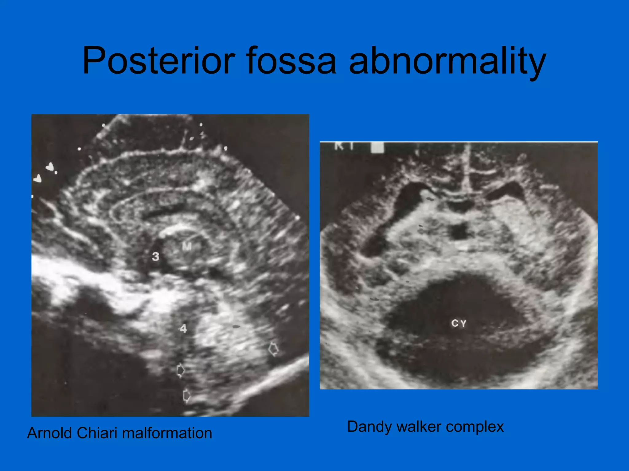 Neonatal transcranial ultrasound | PPT