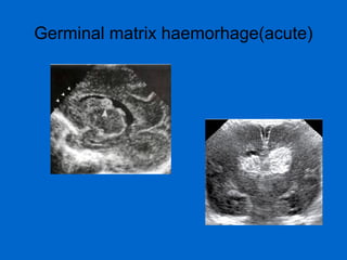 Neonatal transcranial ultrasound | PPT