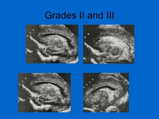 Neonatal transcranial ultrasound | PPT
