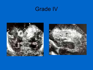 Neonatal transcranial ultrasound | PPT