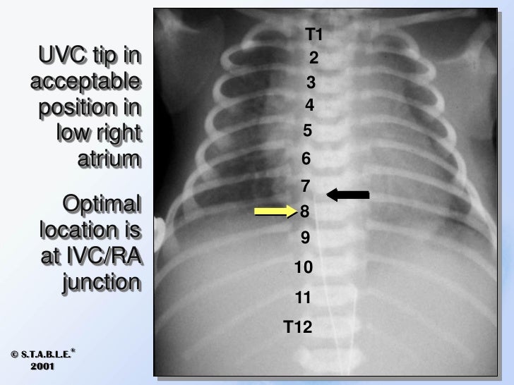 ACEM 201_Neonatal transport and stabilization santi