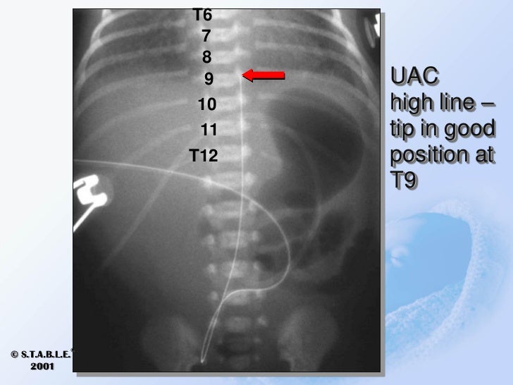 ACEM 201_Neonatal transport and stabilization santi